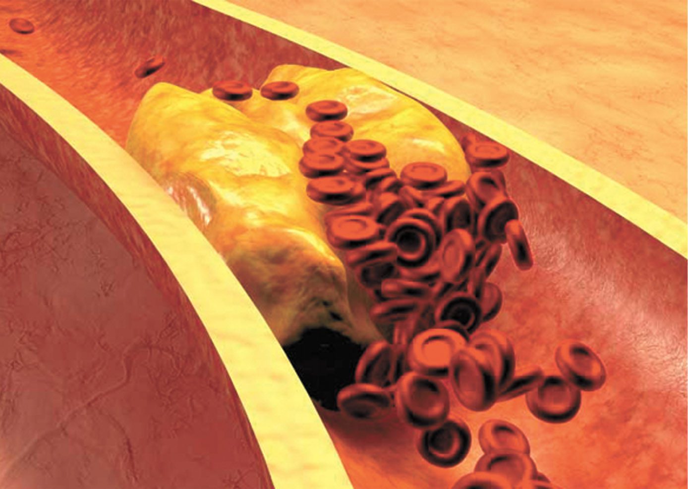 High Cholesterol = High Risk for Debilitating Diseases | Central ...