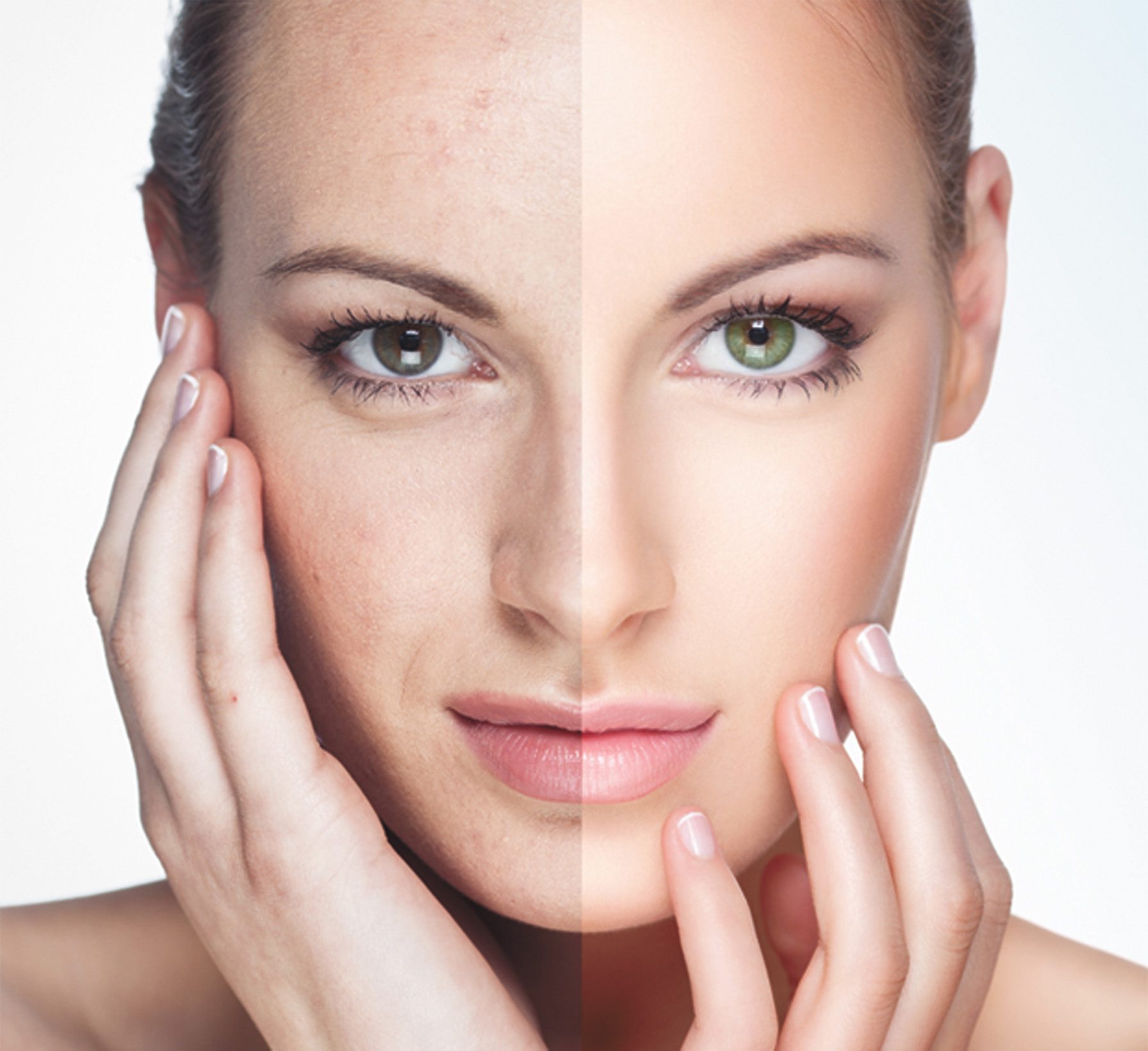 Common Acne Treatment Options | Central Florida Health and Wellness ...