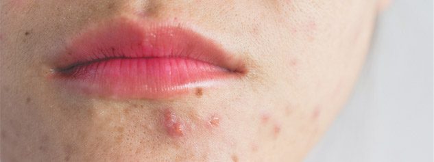 Acne Treatment & New Therapeutic Options | Central Florida Health and ...