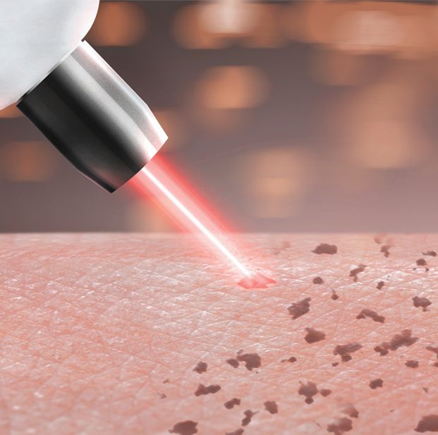 A Skin Cancer Treatment That Doesn’t Require Cutting or Surgery ...
