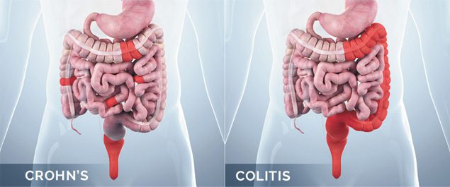 Infusion Treatments for Crohn’s and Colitis Disease are More Targeted ...
