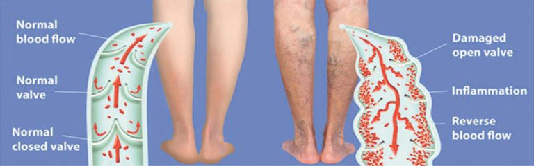 What is Venous Hypertension? | Central Florida Health and Wellness Magazine