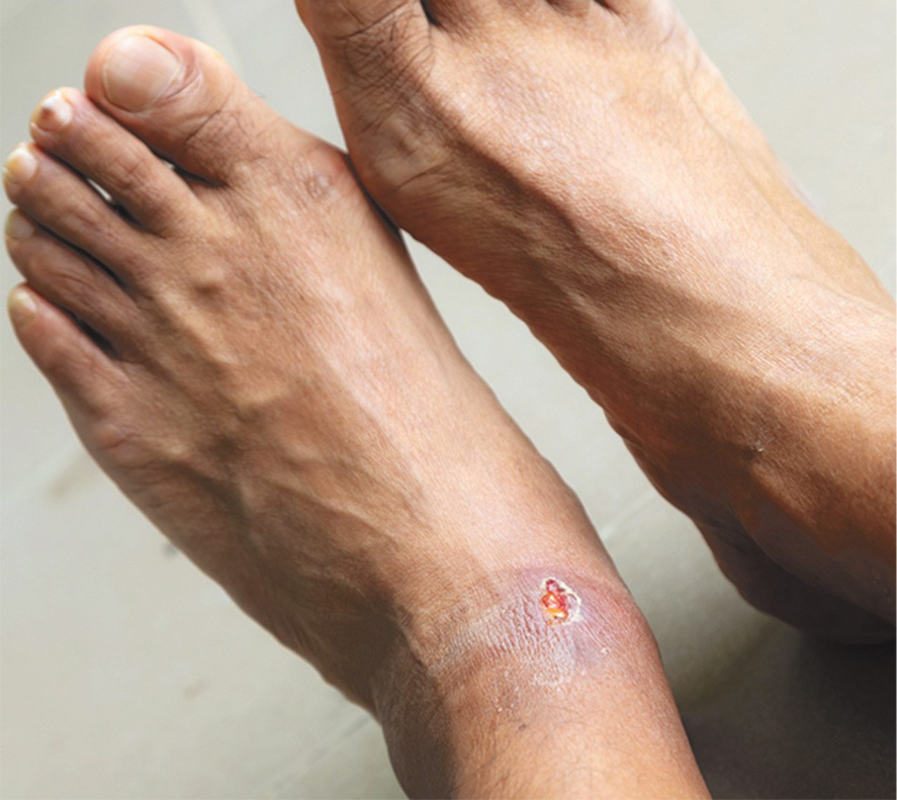 Diabetic Wound Care: Harnessing the Power of Amniotic Membrane ...