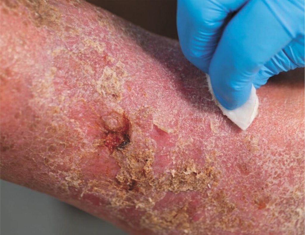 Understanding Venous Leg Ulcers: Causes, Symptoms, and Treatments ...