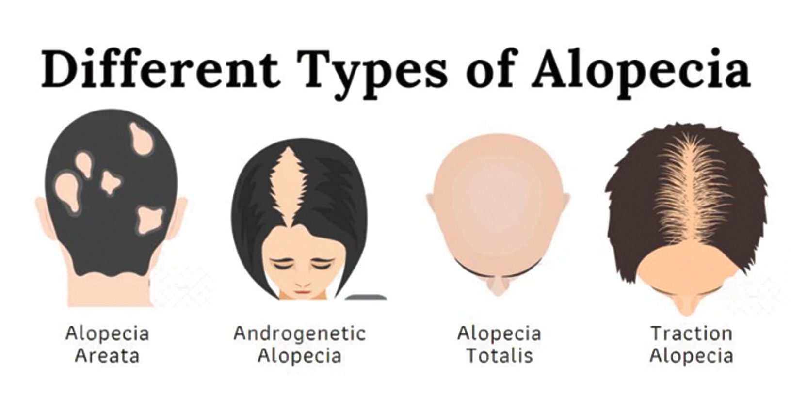Understanding Alopecia: Types, Causes, and New Treatment Research ...